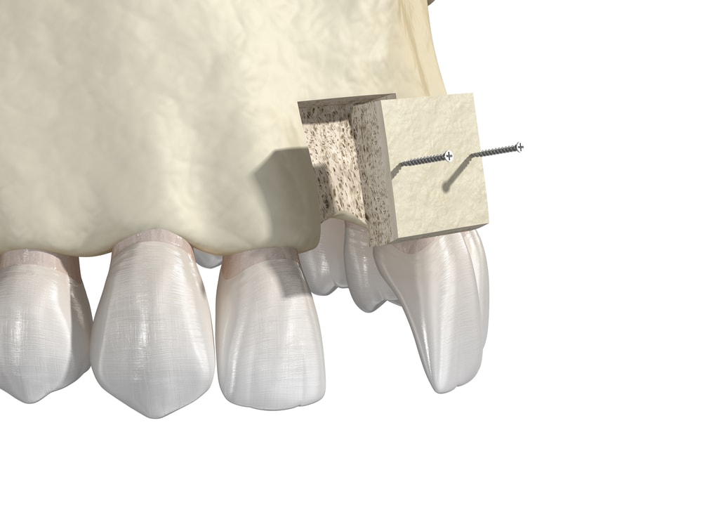 Bone Grafting Cupertino Sunnyvale CA